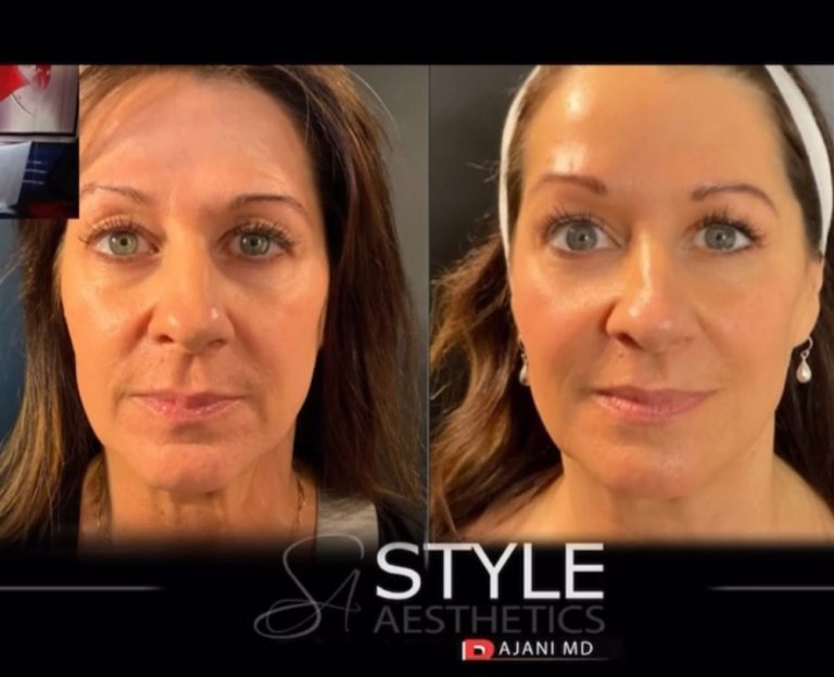 PRF Injections & PRF EZ Gel - Ageless U Med Spa